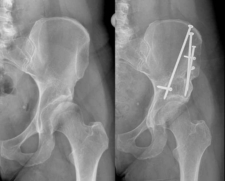 Hip Dysplasia Treatment Options Chicago - Shane Nho, MD, MS