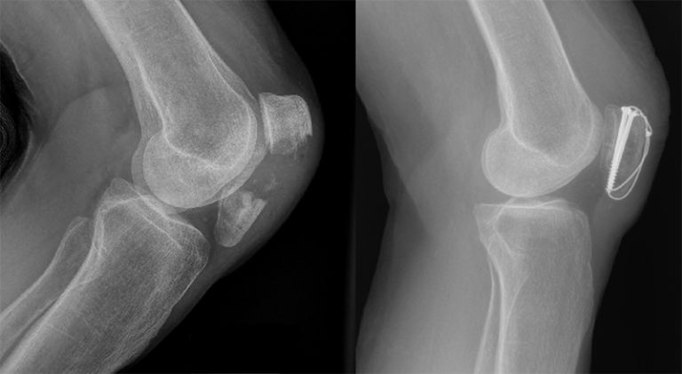 Patella Fractures Treatment Options Chicago - Shane Nho, MD, MS
